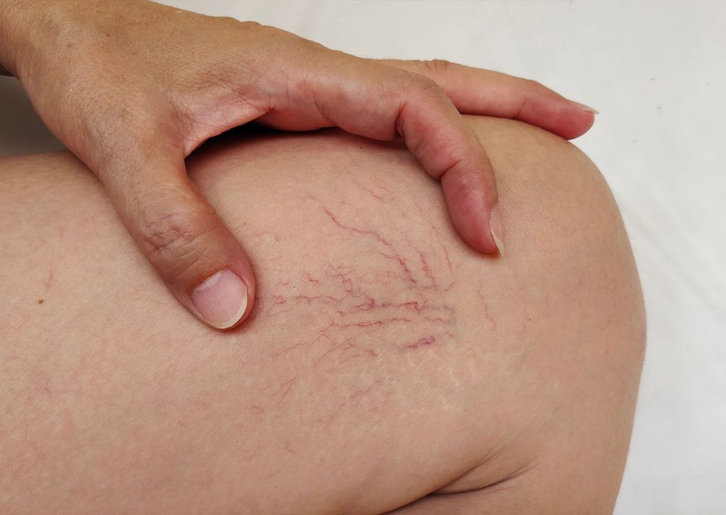 Radiofrequency Endovenous Ablation | FVSA