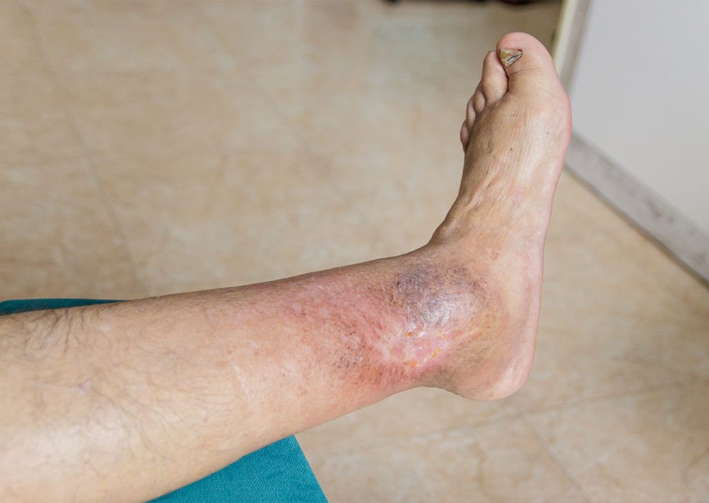 Venous Ulcer Treatment at Fox Valley Surgical